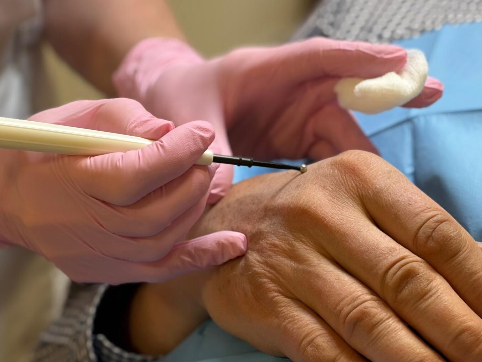 Cauterizare Leziuni Cutanate Brasov - Cabinet Dermatologie